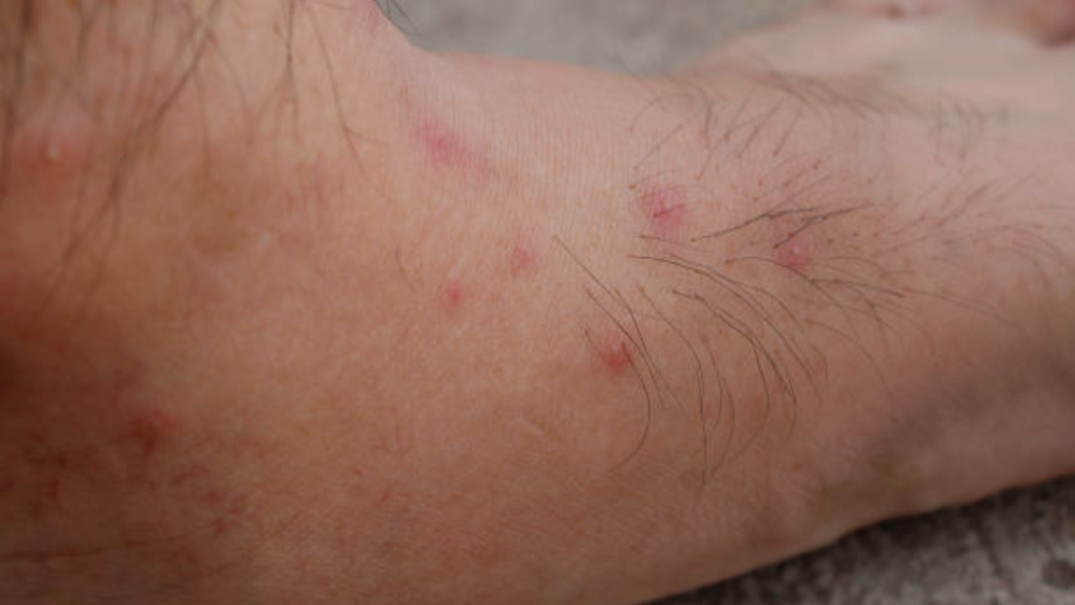 Tipos de picaduras: cómo identificarlas, reconocer síntomas y tratarlas - Goldservice